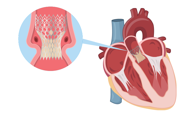 Transcatheter Aortic Valve Replacement (TAVR) | Lehigh Valley Health Network